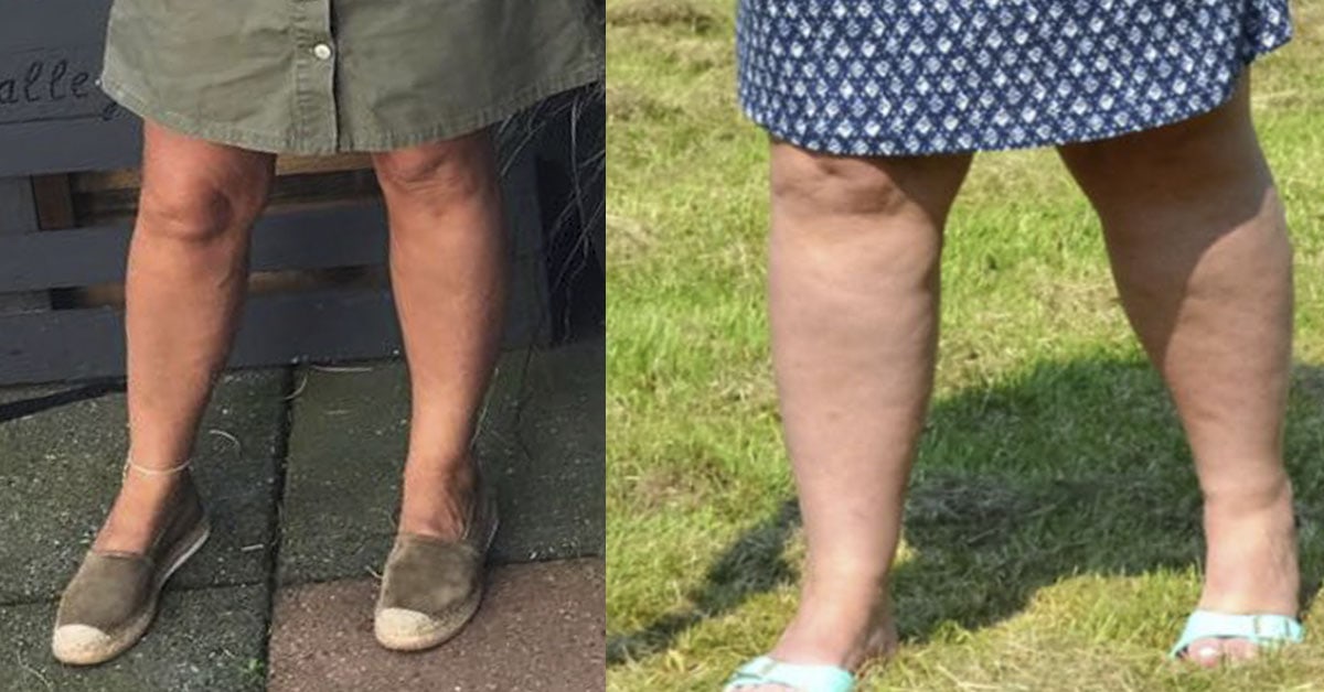 lipoedeem - lipoedeem