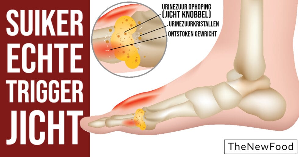 Jicht en gezond koolhydraatarm/keto - TheNewFood